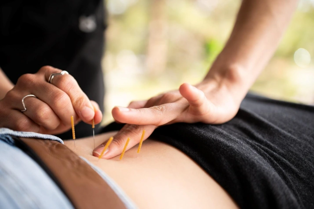 Dry Needling - Apicare Pain Specialist